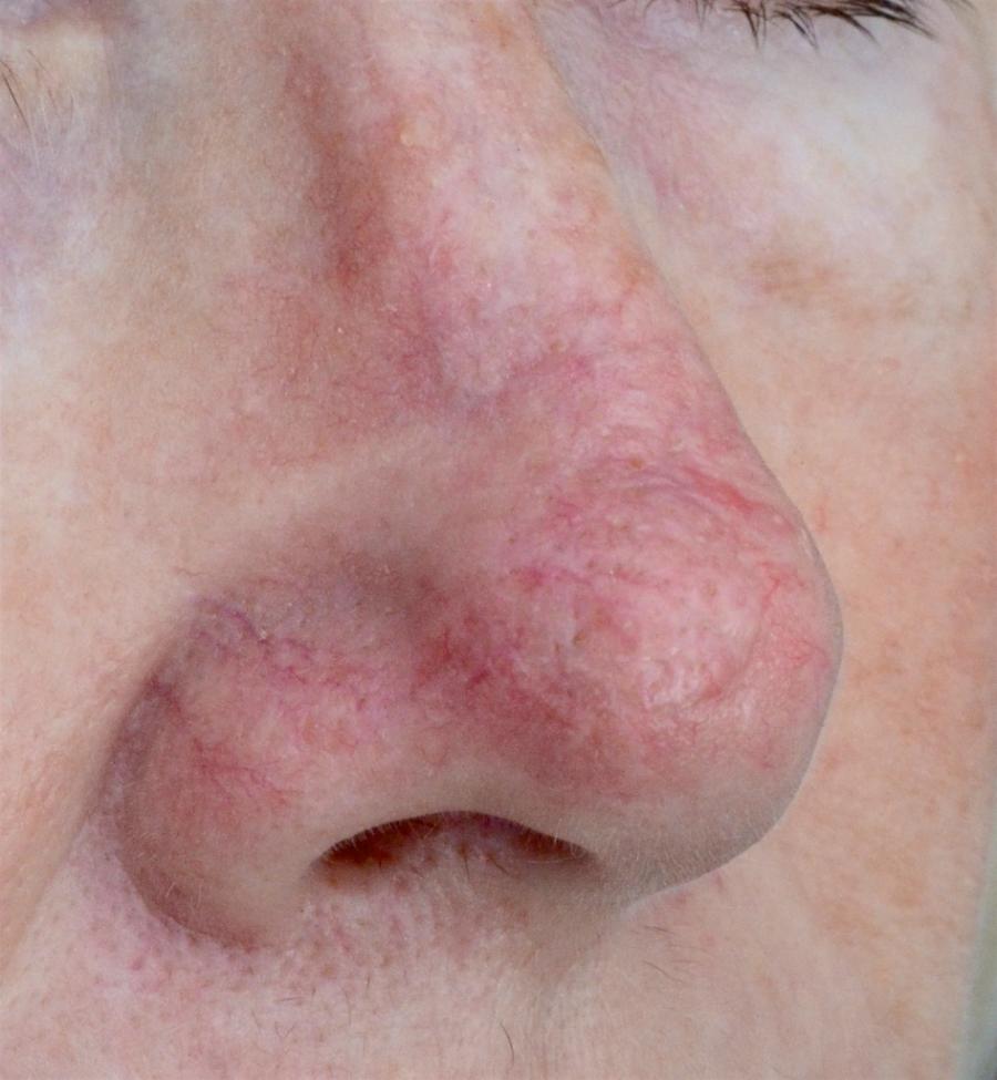 Post Op Wound Healing & Care - Dr Stretch Post Op Wound Healing & Care - Dr Stretch